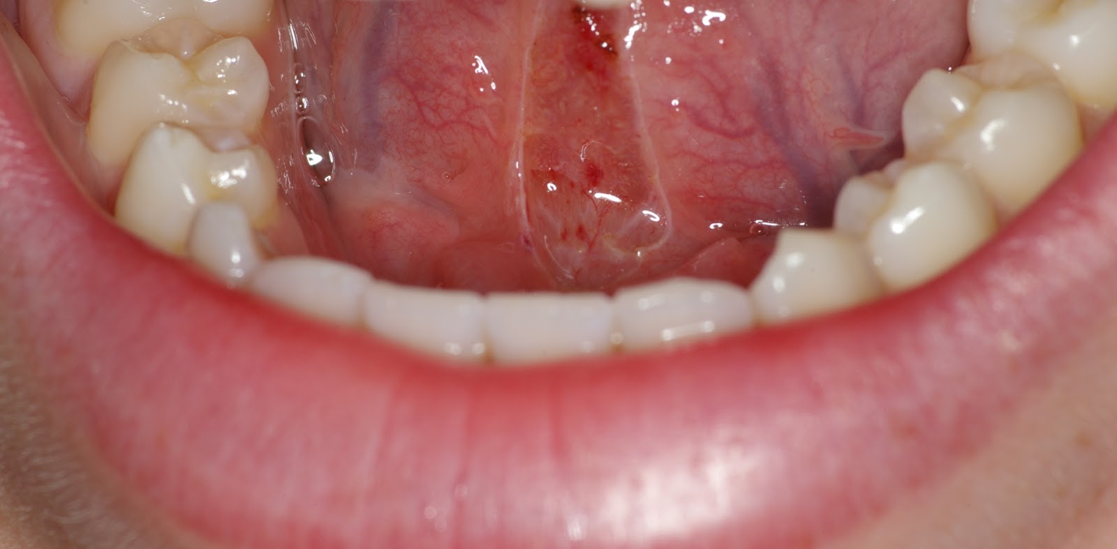 Pediatric Tongue Laceration Repair at Walter Belin blog