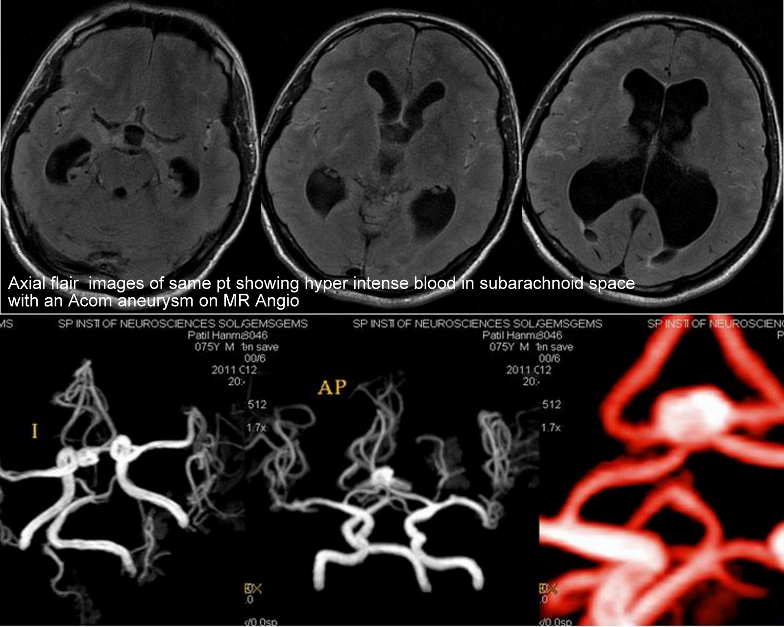 Dr Balaji Anvekar FRCR: Imaging in Sub Arachnoid H'rhage