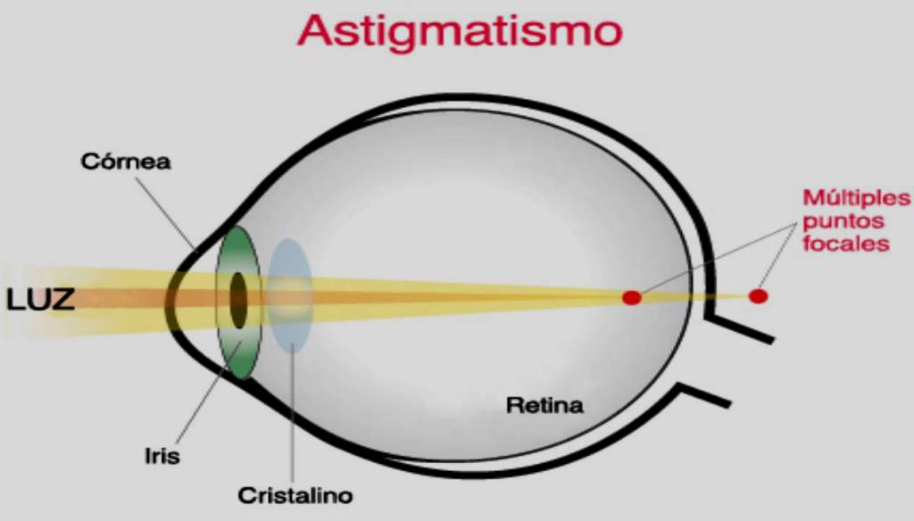 SyM Clínica Ocupacional y Asistencial S.A.C: Astigmatismo: causas y ...