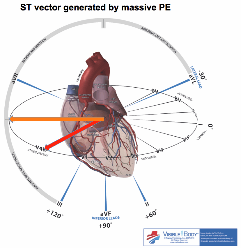 Two EKG patterns of pulmonary embolism which mimic MI
