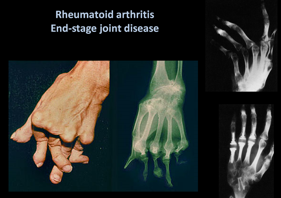 Multiple Sclerosis Research: Do DMTs delay the onset of secondary ...