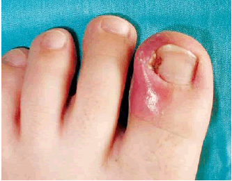 Medicina Natural: ALGUNOS MÉTODOS CASEROS PARA CURAR Y PREVENIR LA UÑA ...