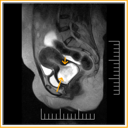 Pedunculated Cervical Fibroid Polyp - Sumer's Radiology Blog