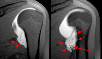 MRI Musculo-Skeletal Section: Labrum