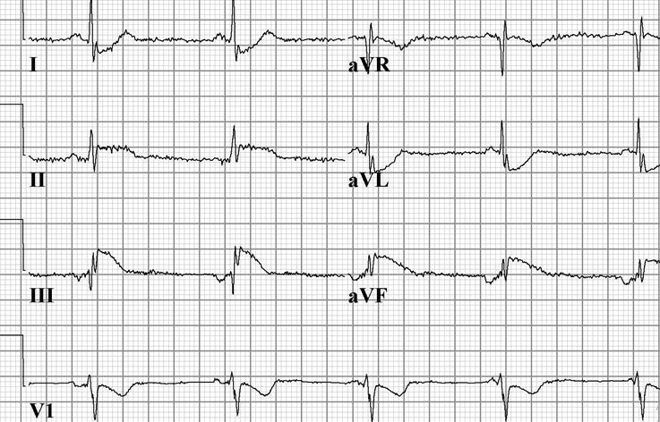 Atrial Rhytm - Ritme Atrium - Belajar EKG