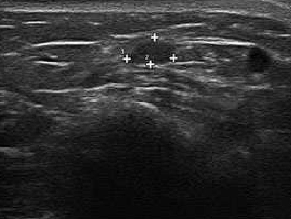 Asociacion Peruana de Ultrasonido en Anestesia Regional y Dolor