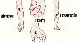 PRIMERS AUXILIS: UT 1: FERIDES