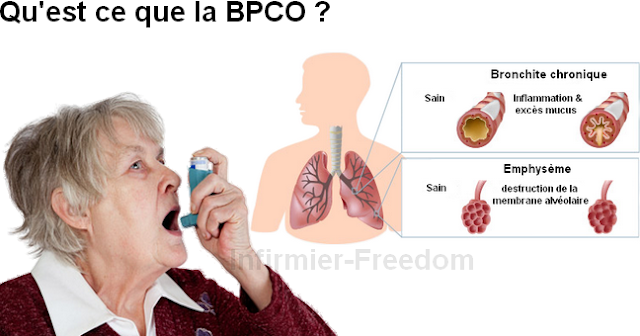 BPCO : Bronchopneumopathie chronique obstructive ~ Santé et les soins ...