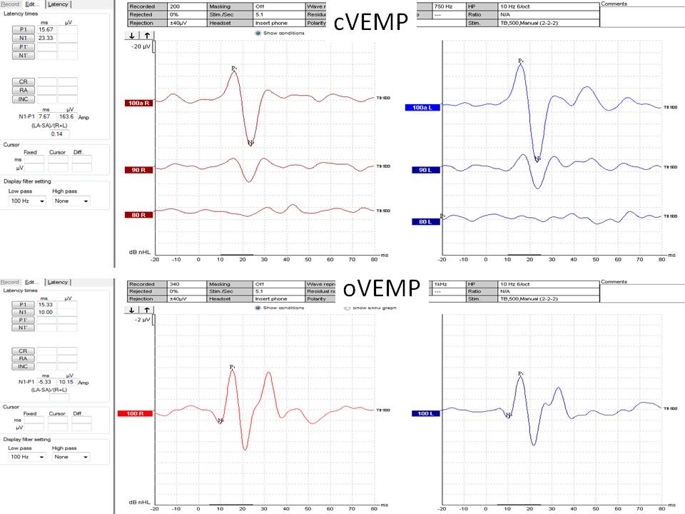 Neurociencias de la memoria y del equilibrio: ESTUDIO DE LAS ...