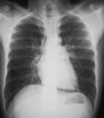 ¿Sabemos leer una RX de tórax? Parte 2: Principales signos radiológicos.