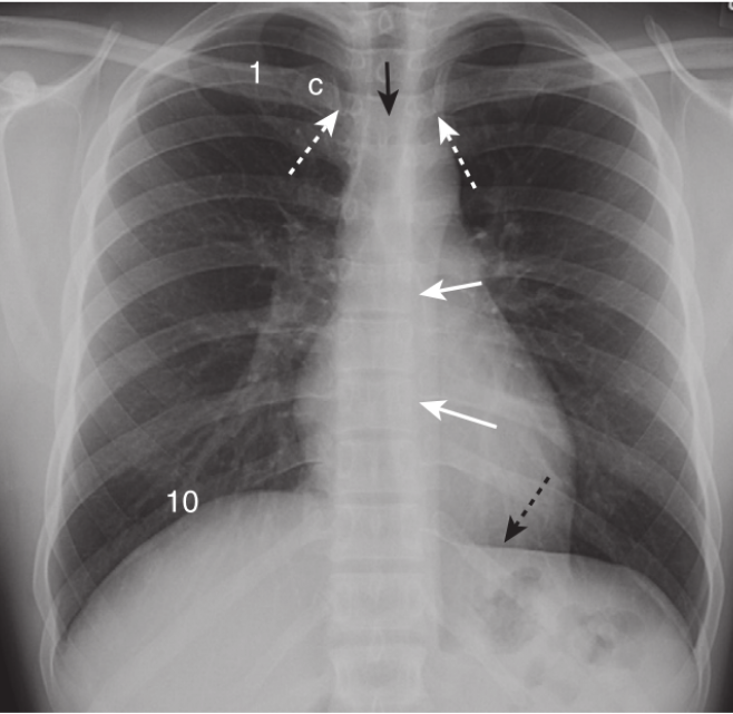Rozpoznawanie technicznie dobrego zdjęcia klatki piersiowej