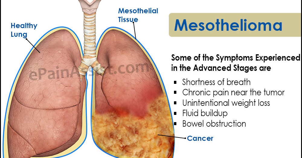 Meshtholioma cancer cure treatment