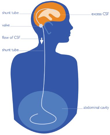 shunt - définition - C'est quoi