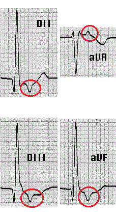 Dr. Rafael Soto - Electrocardiografía - Cardiología clínica: Onda P ...