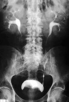 Rayos 2011: Estudios Contrastados del Aparato Urinario