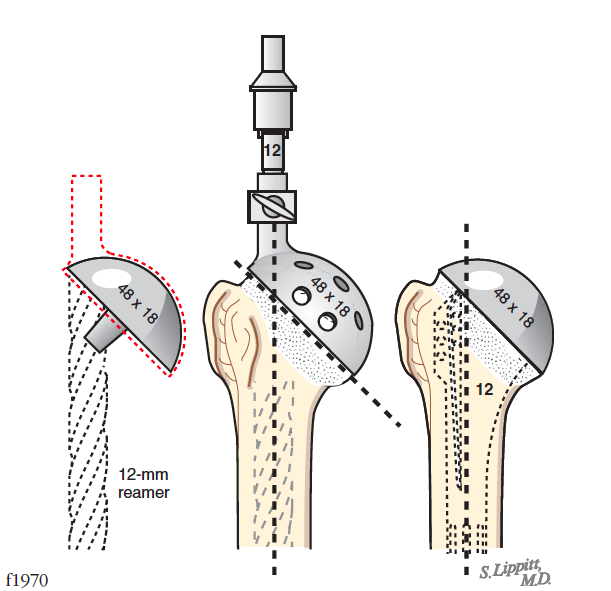 UW Shoulder and Elbow Academy: Humeral head osteotomy in shoulder ...