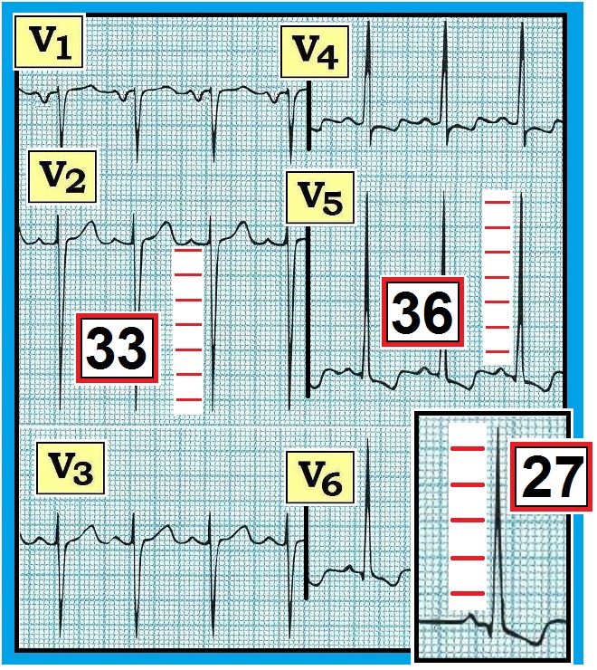 ECG Interpretation: ECG Interpretation Review #73 (LVH – Hypertrophy ...