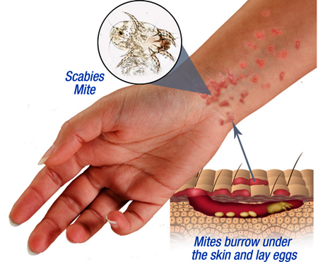 cara mengobati penyakit kudis ~ 10obatkesehatan