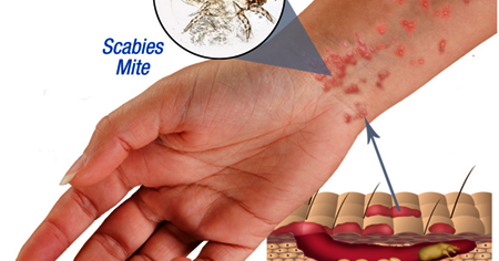 cara mengobati penyakit kudis ~ 10obatkesehatan