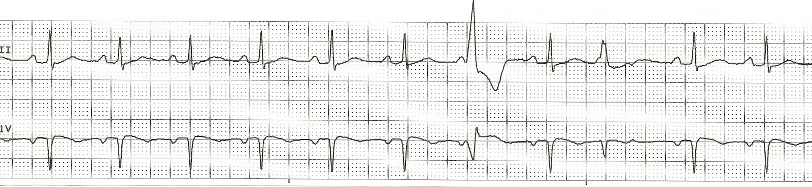 EKG Rhythm Strip Quiz 72