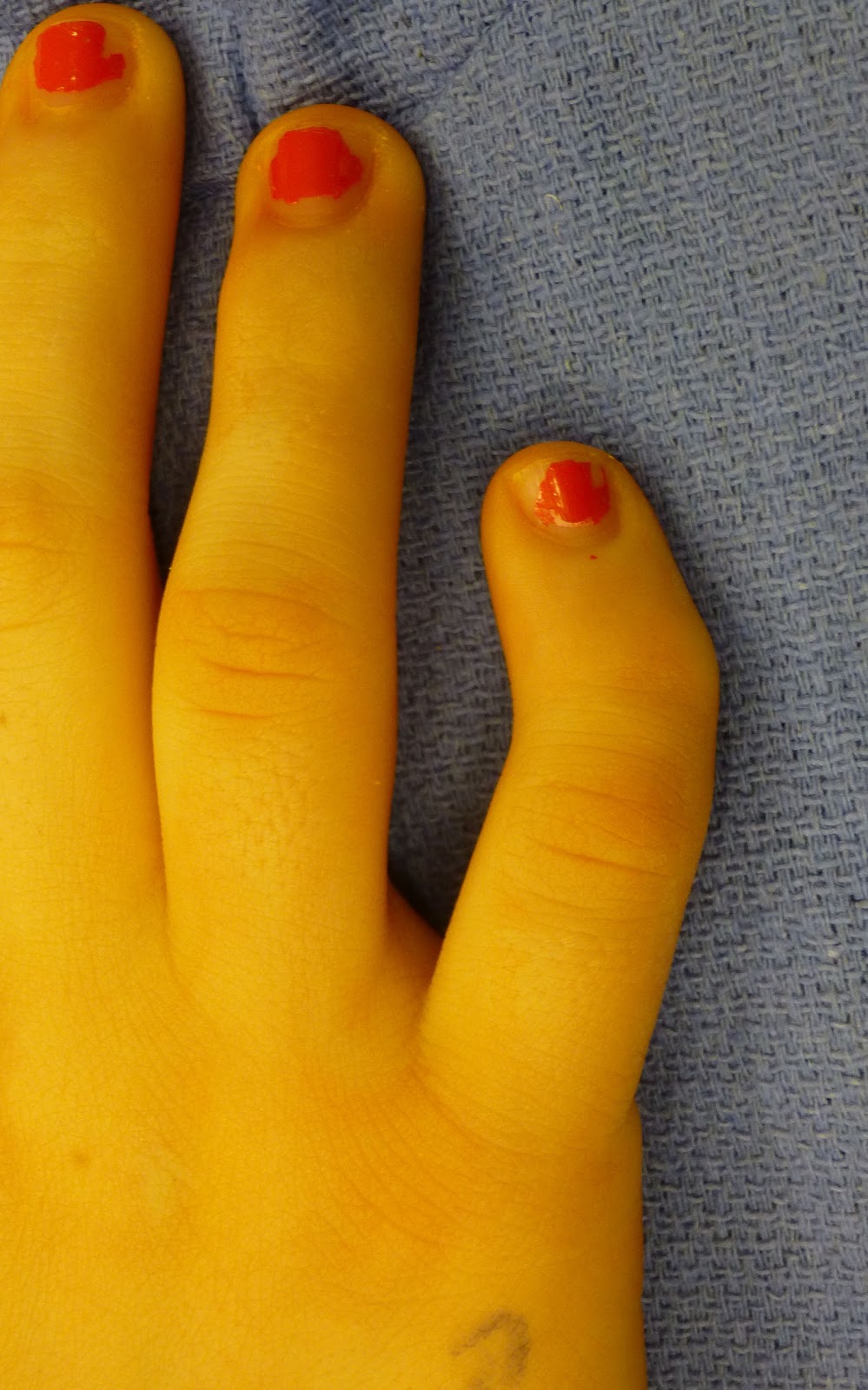 Clinodactyly | Congenital Hand and Arm Differences