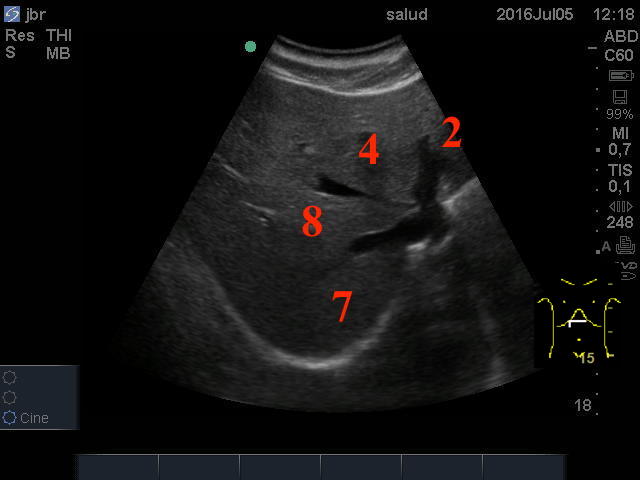 Ecografía en Atención Primaria: SEGMENTOS HEPÁTICOS