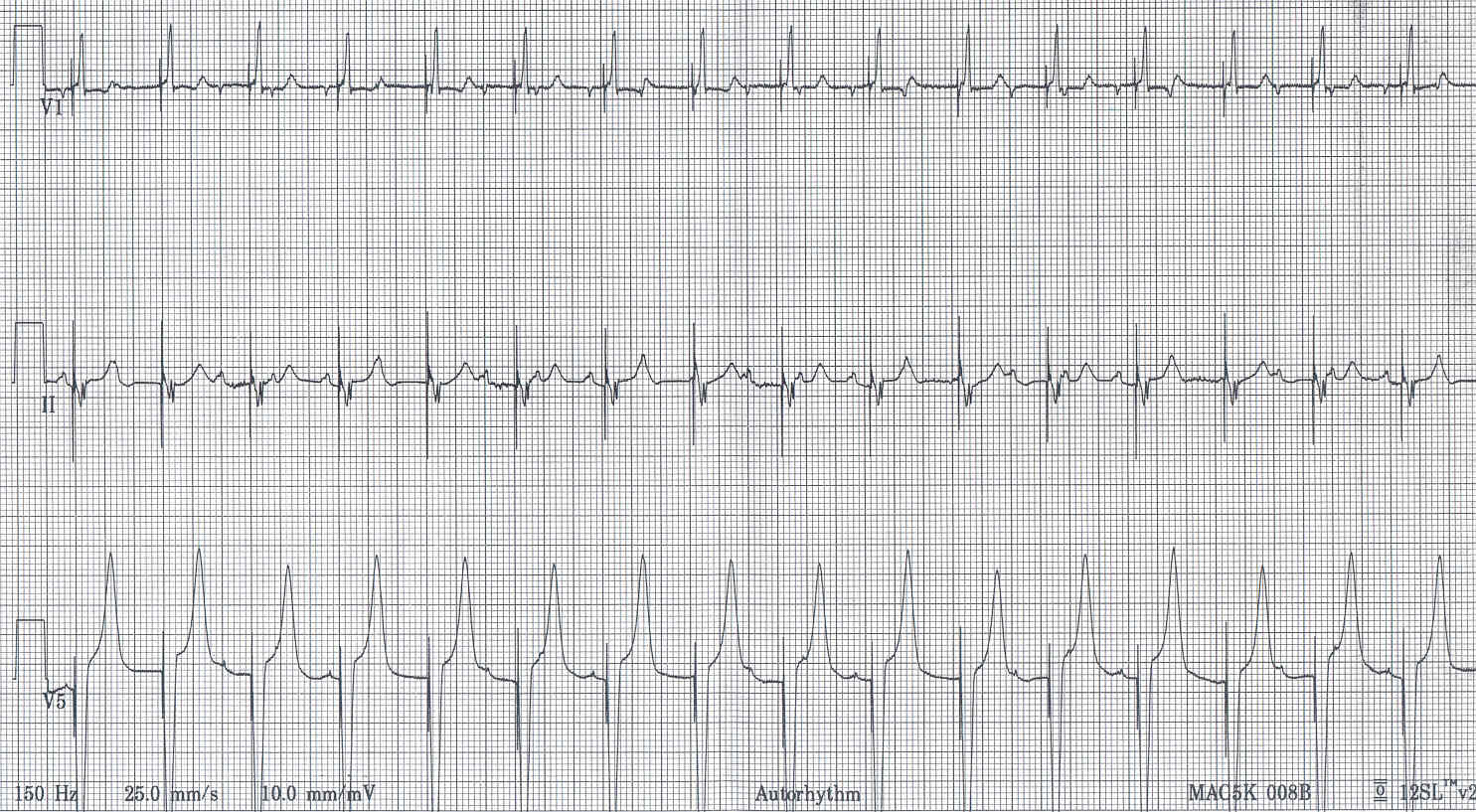Pedi cardiology: EKG: Pacing, Interpret this.