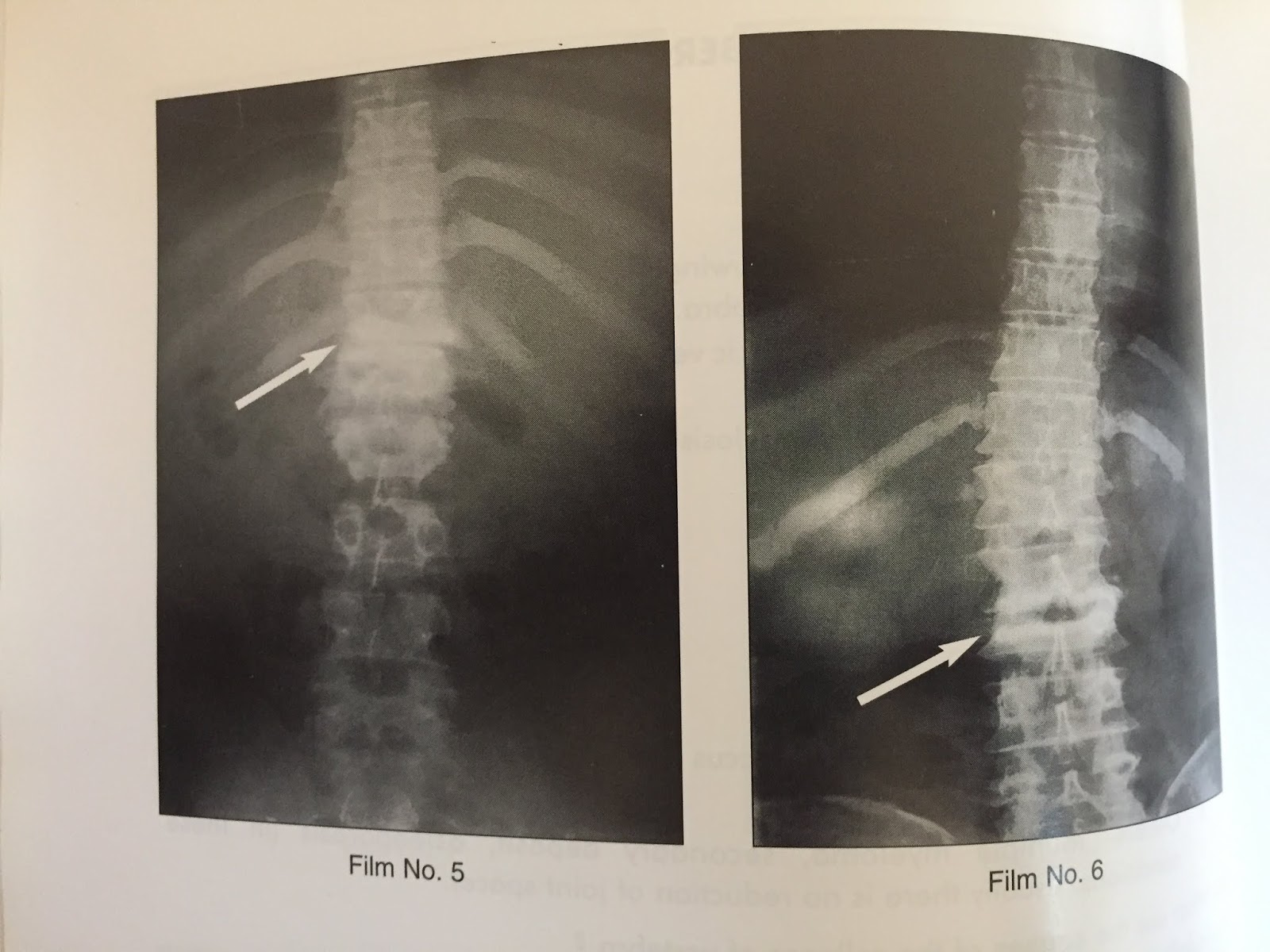 XRAYS OF TUBERCULOSIS OF SPINE