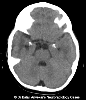 Dr Balaji Anvekar FRCR: Bilateral symmetric medial temporal calcification