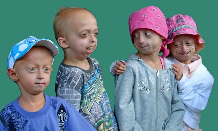 LA PROGERIA