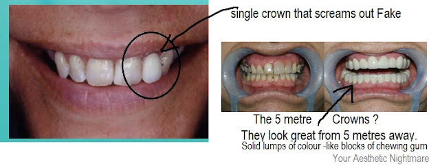 What is the lifespan of a Dental Crown or Cap and Why do prices vary so ...