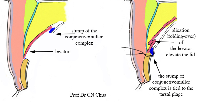 Eyelid Surgery by Prof Dr CN CHUA 蔡鐘能: Doc, Could You Balance My Eyes ...