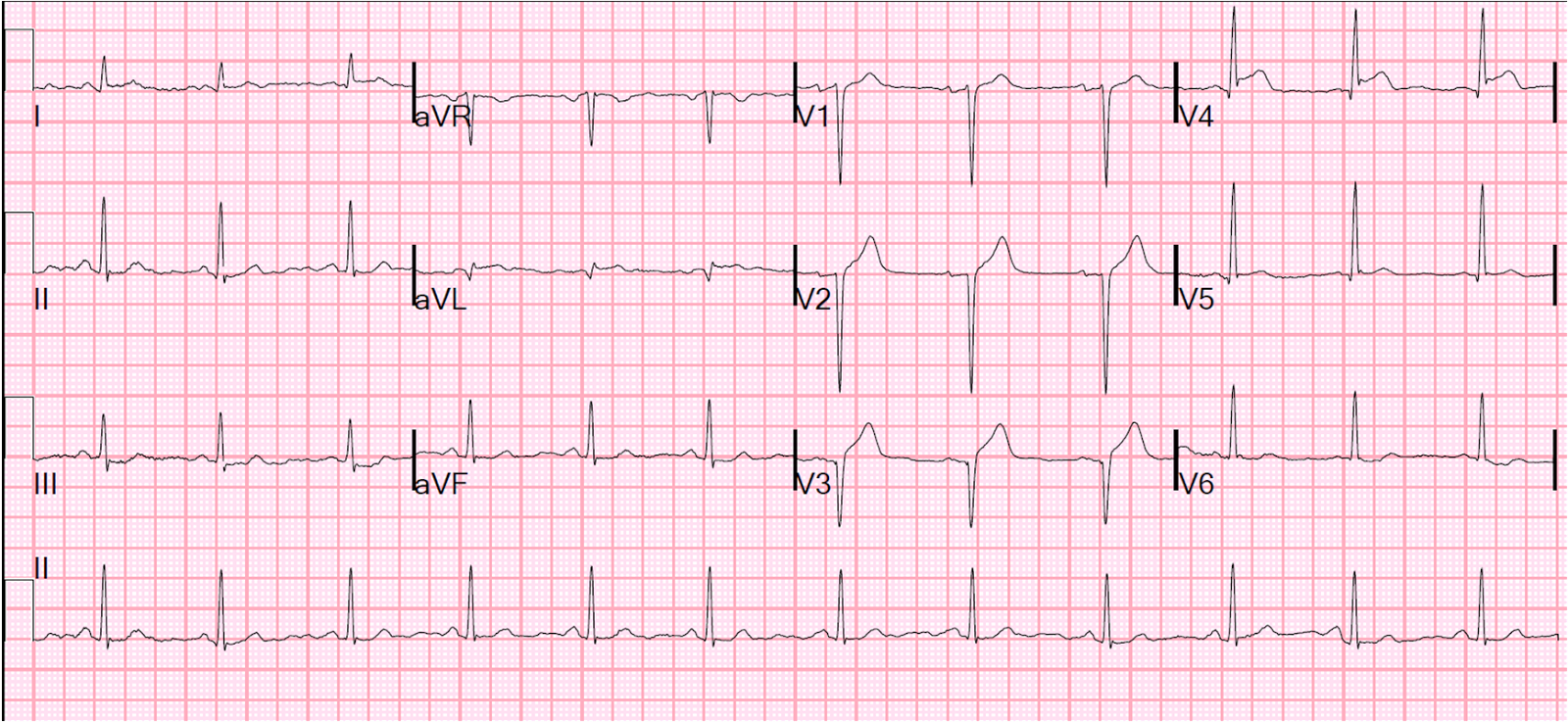 Dr. Smith's ECG Blog: Subtle LAD Occlusion with Pseudonormalization of ...