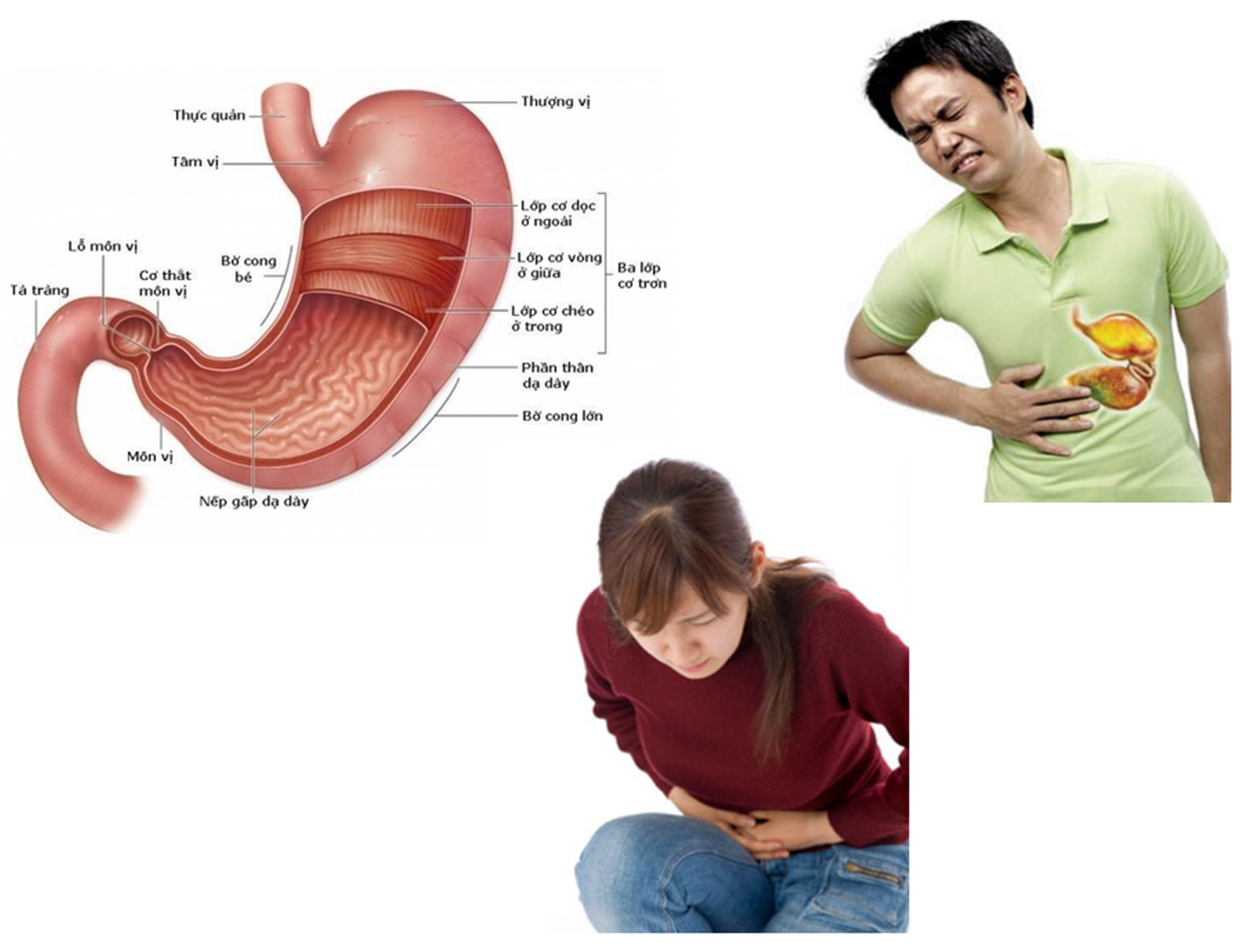 Bio-stomach: VIÊM LOÉT DẠ DÀY TÁ TRÀNG