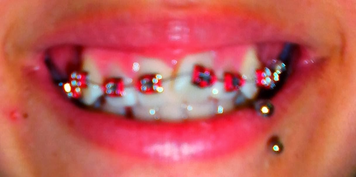 Mis Brackets: Paso a Paso [Mi experiencia]: 03/04/2014 - Cambio de Ligas