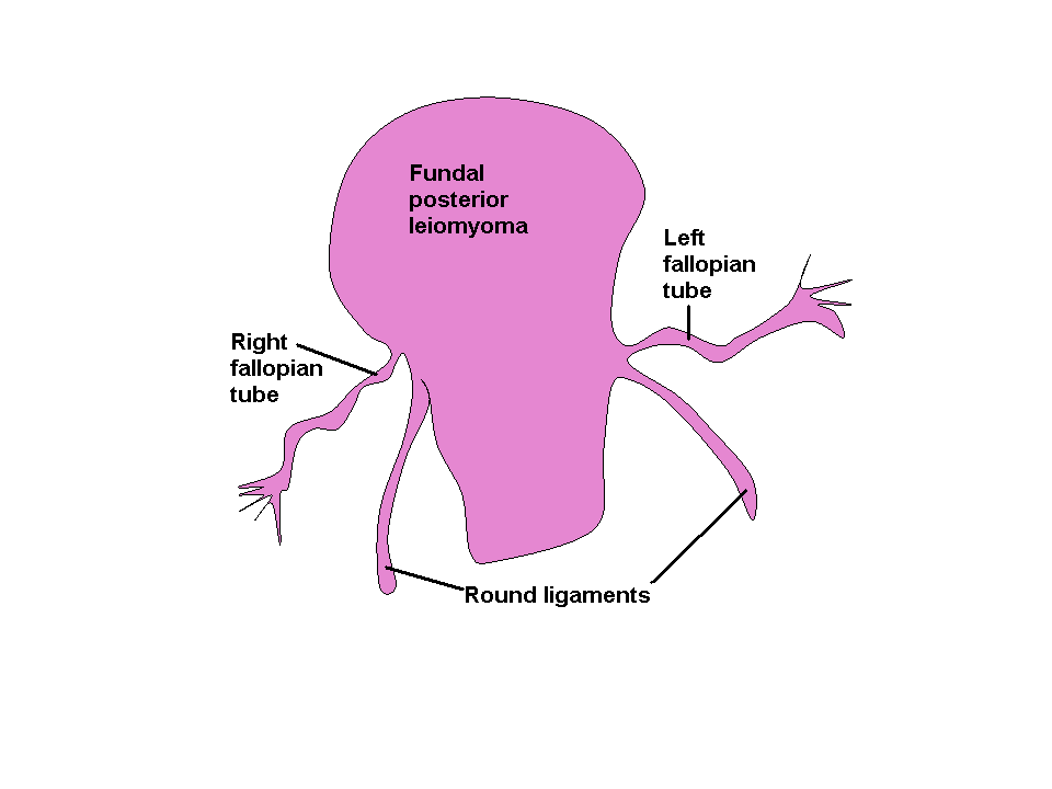 शशांक परुळेकर: Bonney's Hood Operation: Inverted T-shaped Incision