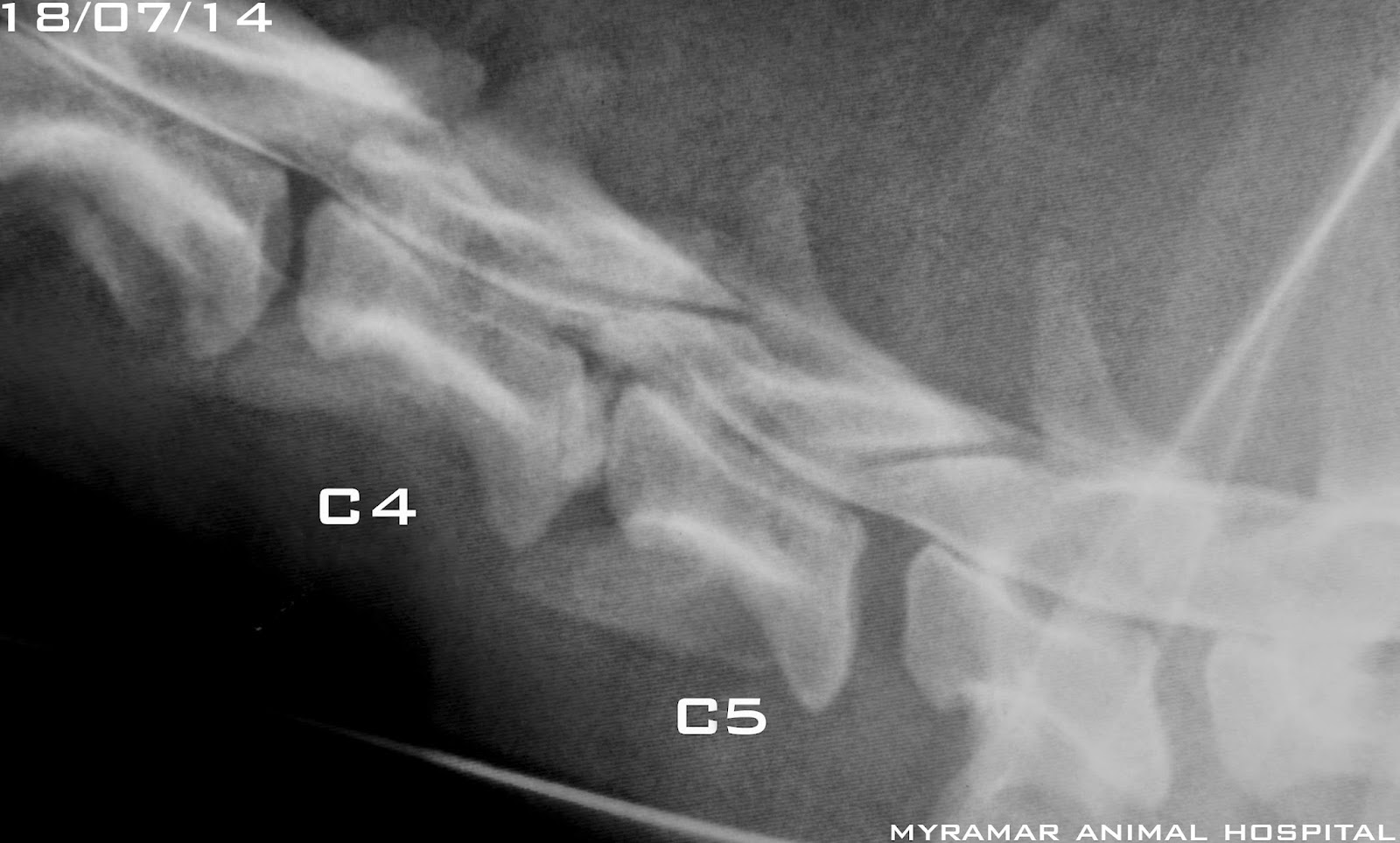 CIRUGÍA DE COLUMNA: ANTONIO. C4-C5. Slot cervical