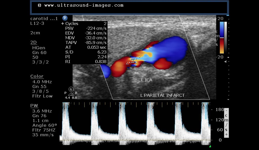 cochinblogs: Severe left internal carotid artery stenosis: