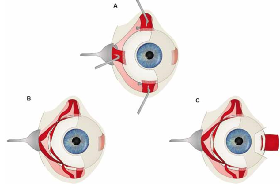 Cirugías en estrabismo