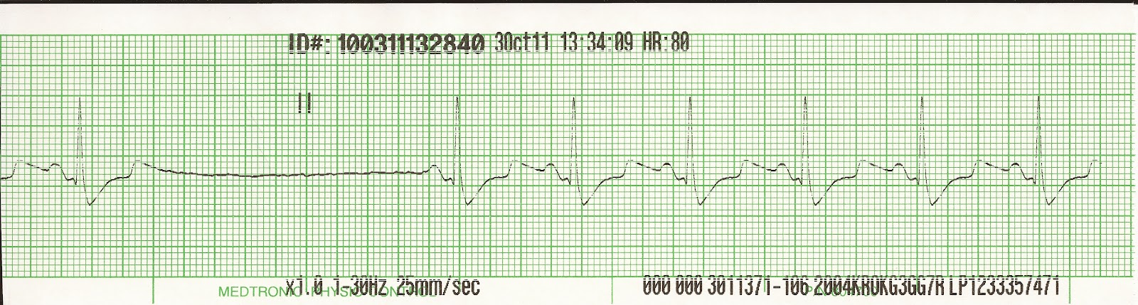 EKG Rhythm Strips 03