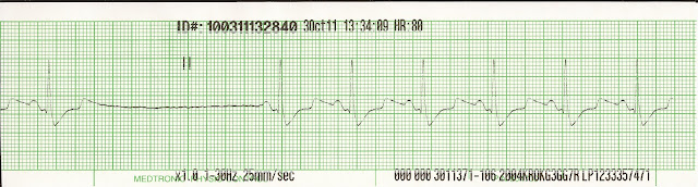 EKG Rhythm Strips 03
