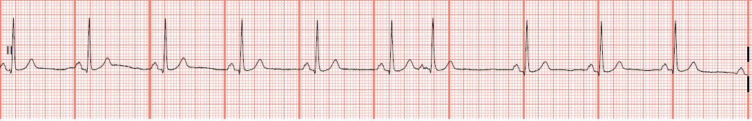 EKG Rhythm Strip Quiz 78