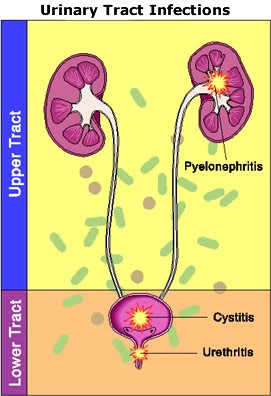 Lower Urinary Tract Infection Cartoon