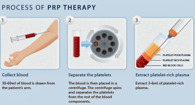 PRP Treatment - BELLVS