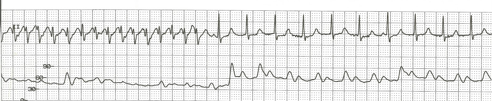 EKG Rhythm Strips of Unstable SVT with Arterial Blood Pressure Waveform