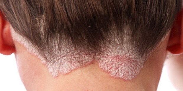 Rogaine Malaysia: Scalp Diseases