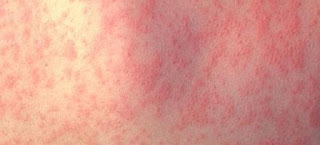 Cara Mengobati Biduran atau Gabagen Pada Anak - vera-valentina