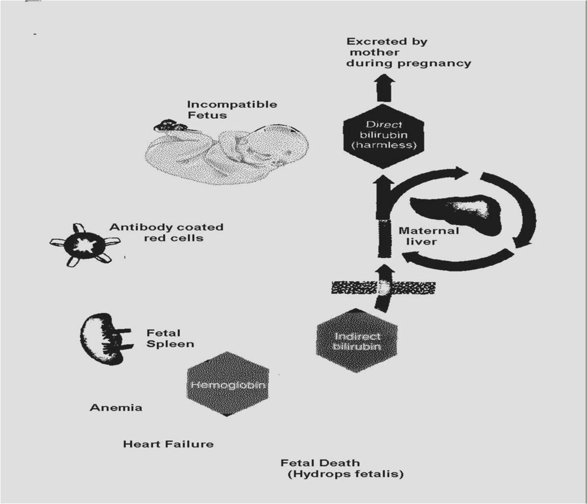Haemolytic Disease of the Newborn (HDN)
