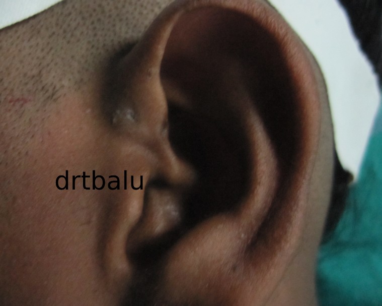 drtbalu's otolaryngology resources: Preauricular sinus compete excision ...