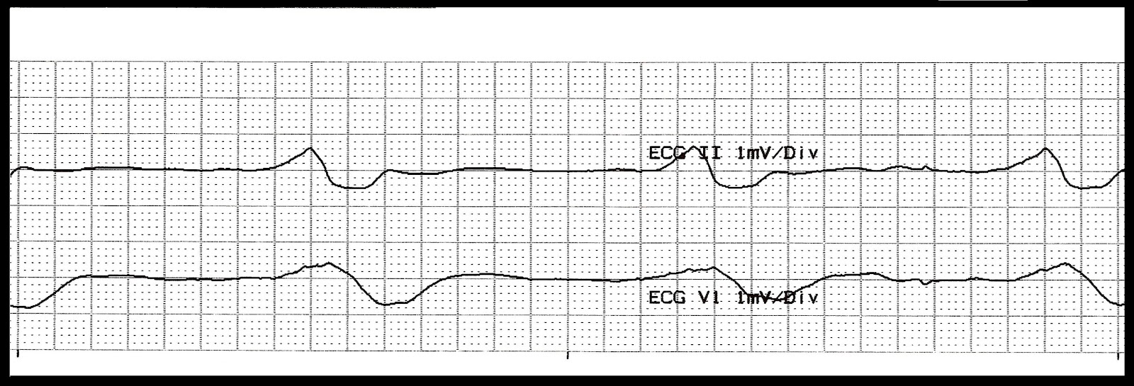 Basic EKG Rhythm Test 34